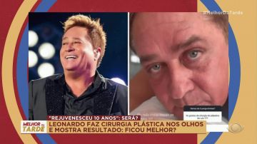 Leonardo faz cirurgia plástica nos olhos e mostra resultado na web